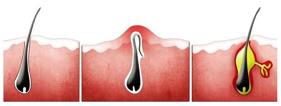 La barba y el pelo encarnado: cómo prevenirlos – Beauty Supply